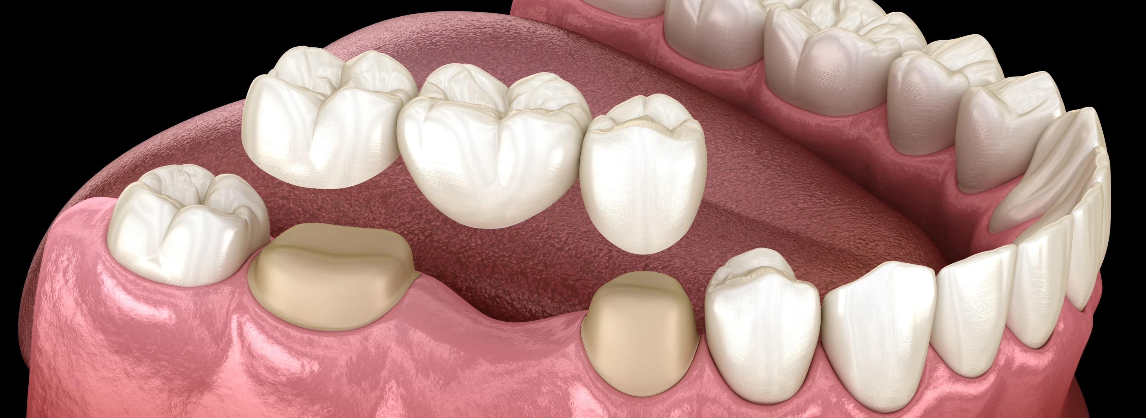 Bridge dentaire | Chirurgien-dentiste à Mérignac (33700)